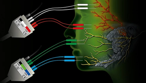 langer medical - OM - ENT surgery - neuromonitoring - IONM