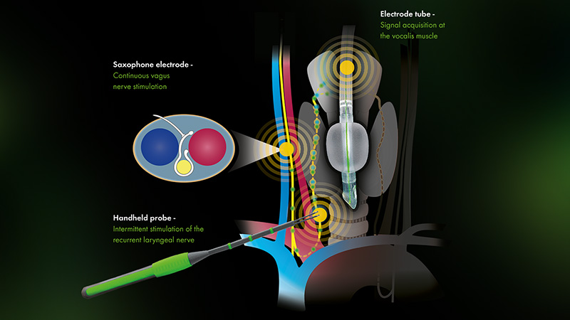 langer medical - thyroid surgery - neuromonitoring IONM