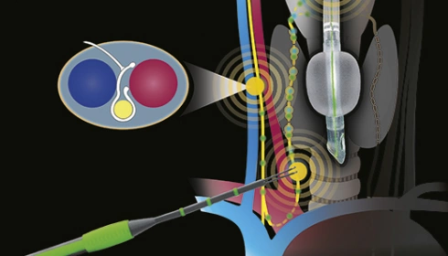 langer medical - thyroid surgery - neuromonitoring IONM